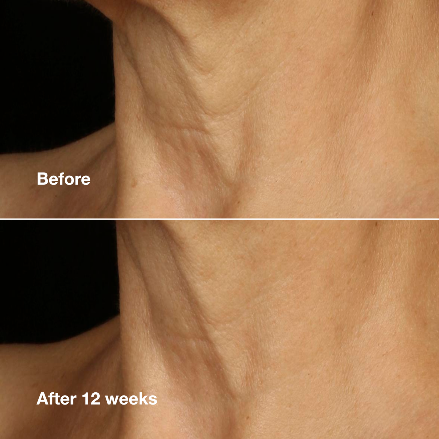 Clinique Smart Clinical Repair™ Lifting Face + Neck Cream | Clinique